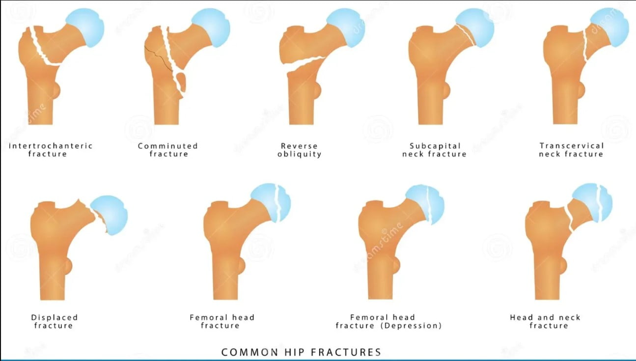 Kako Preživeti Prelom Kuka I Povratiti Punu Pokretljivost - Vaša ...